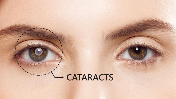 What Are Cataracts and How Can They Be Prevented? - Daily EyewearDigest